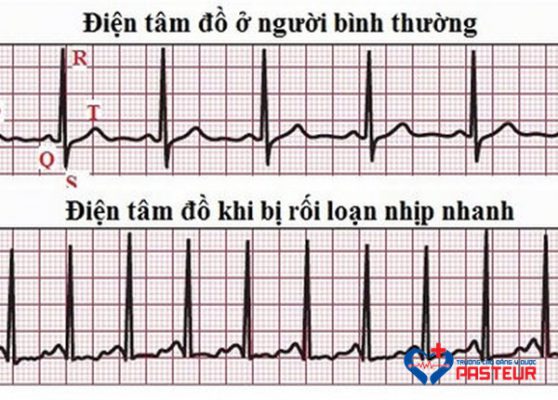 Chẩn đoán nhịp tim nhanh như thế nào?